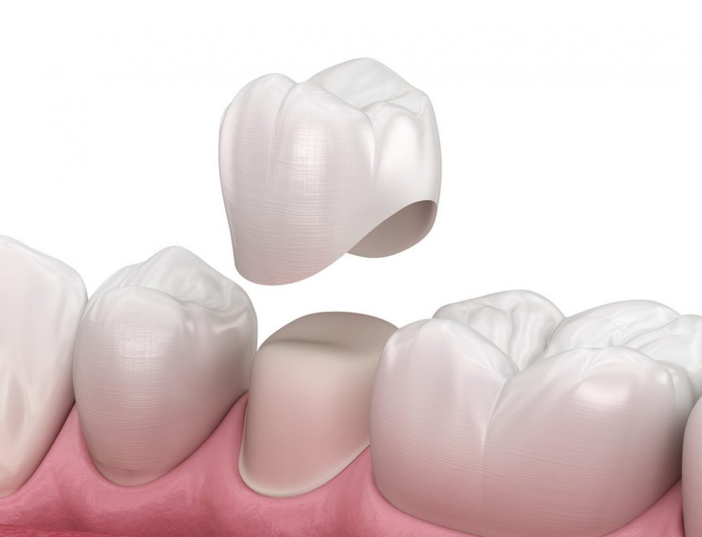Bump on Your Gums - Dental Conditions | Dental Arts San Diego
