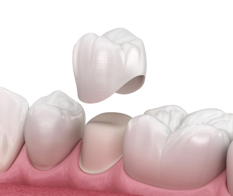 Crown Fell Out - Dental Conditions in San Diego | Dental Arts San Diego