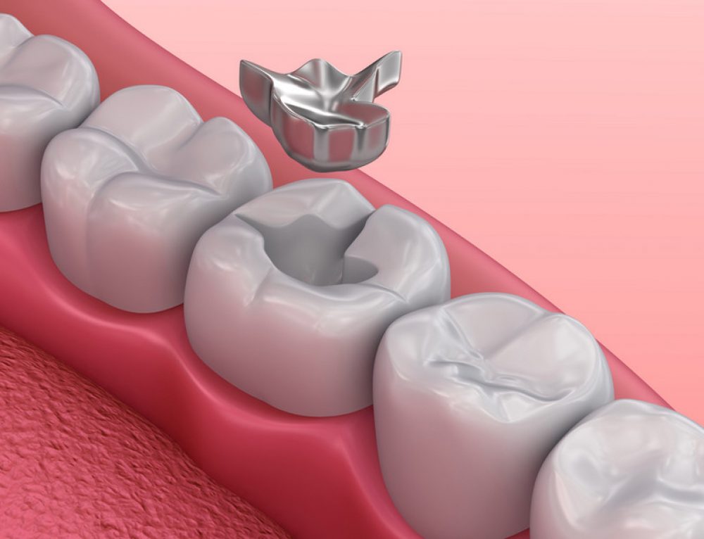Bump on Your Gums - Dental Conditions | Dental Arts San Diego