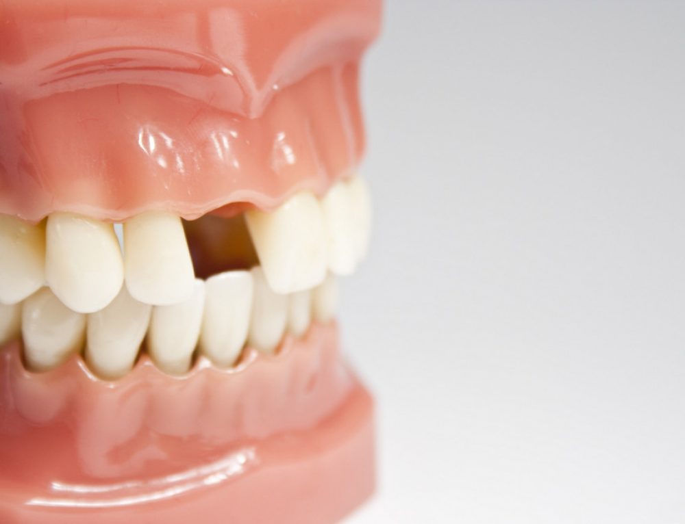 Bump on Your Gums - Dental Conditions | Dental Arts San Diego