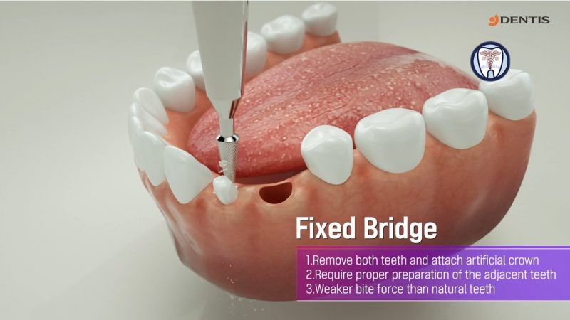 How do we replace missing teeth? ｜ Dental Arts San Diego