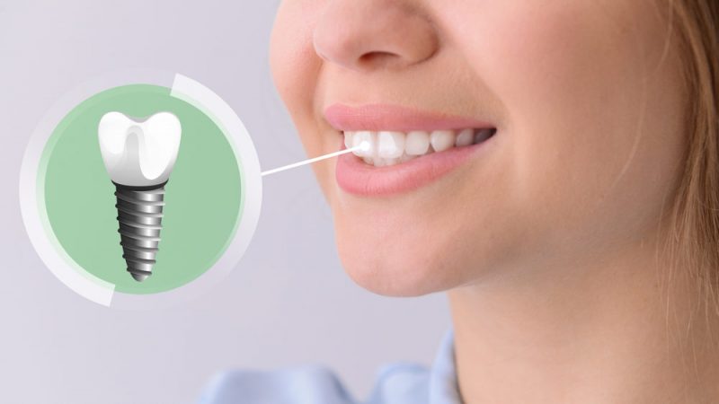 Introduction to Implant Series ｜ El Cajon Family Dentist