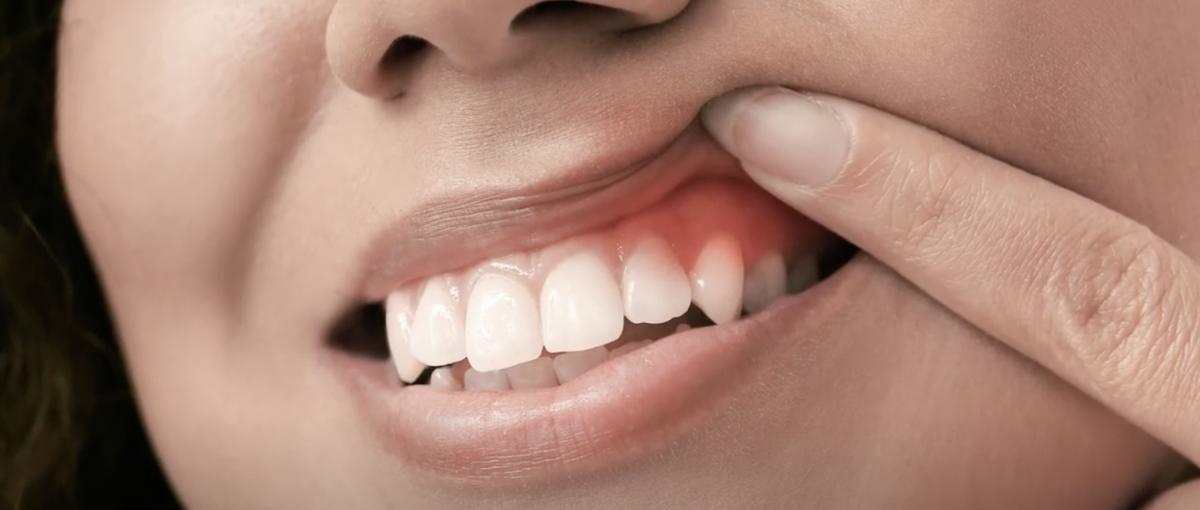 How To Stop Bleeding from the Mouth