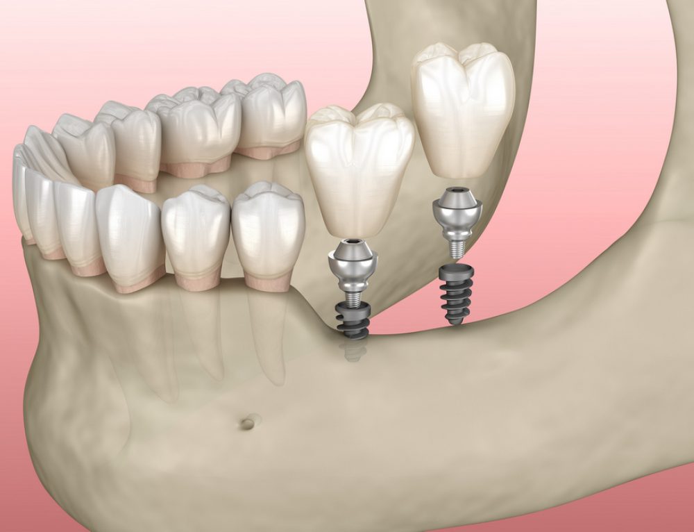 Dental Implants For Seniors With Bone Loss | Detroit Chinatown