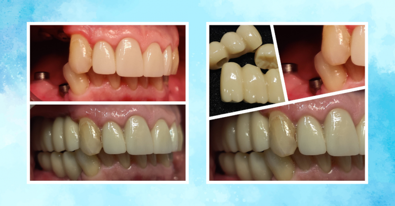 DENTAL CASE STUDIES - Dental Arts San Diego